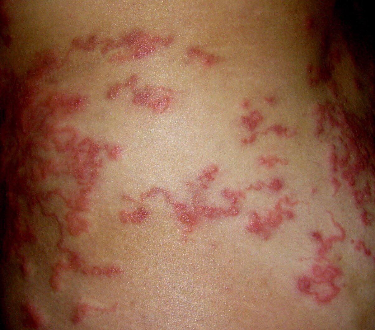 Cutaneous Larva Migrans | HELLO SKIN by หมอผิวหนัง