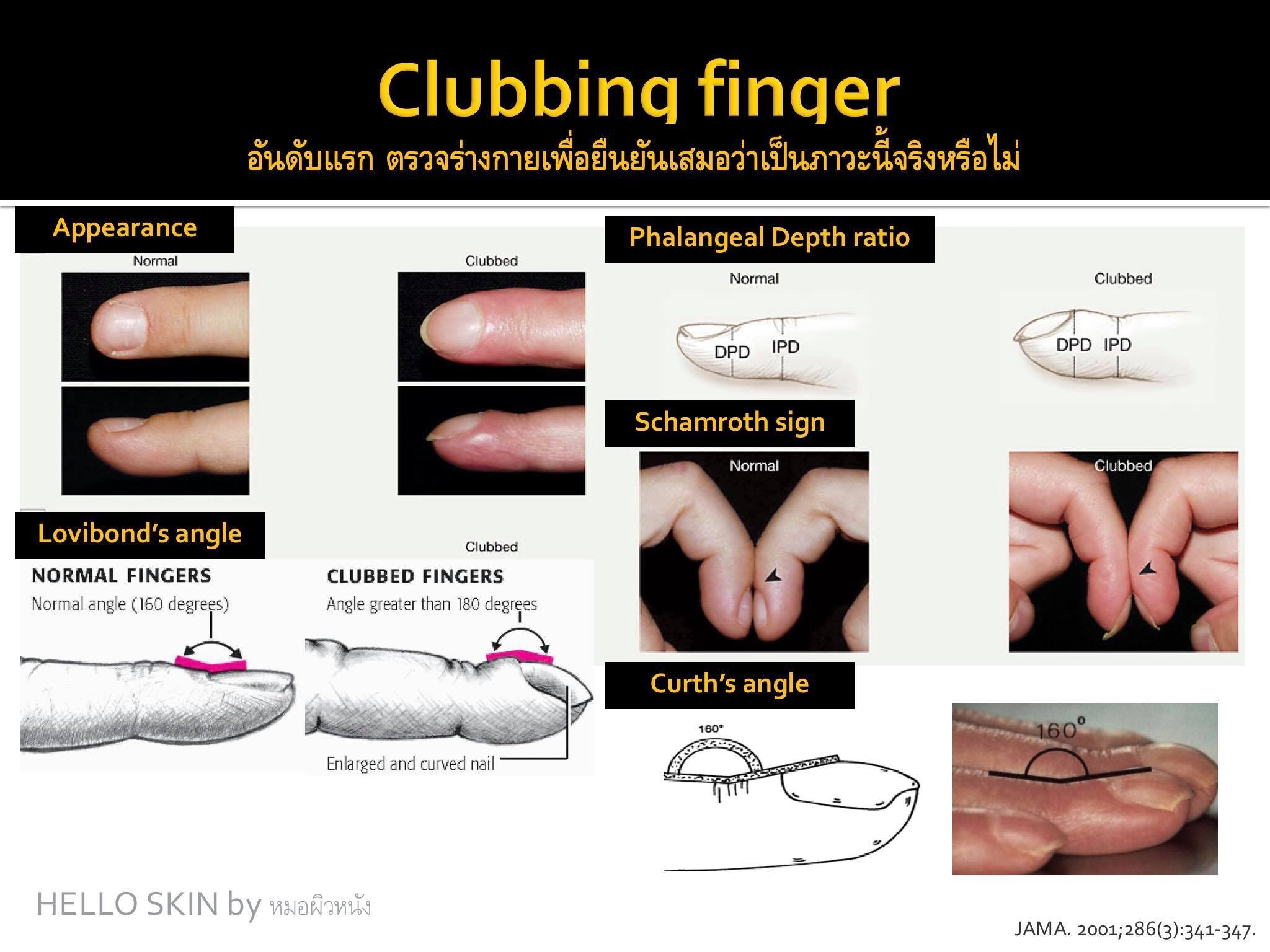 Approach to Clubbing fingers | HELLO SKIN by หมอผิวหนัง