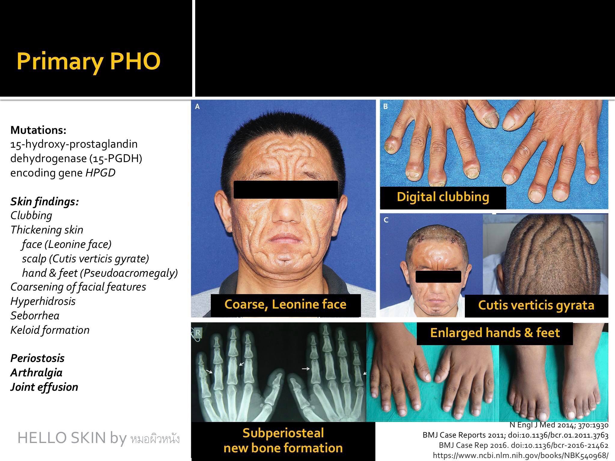 Approach to Clubbing fingers | HELLO SKIN by หมอผิวหนัง