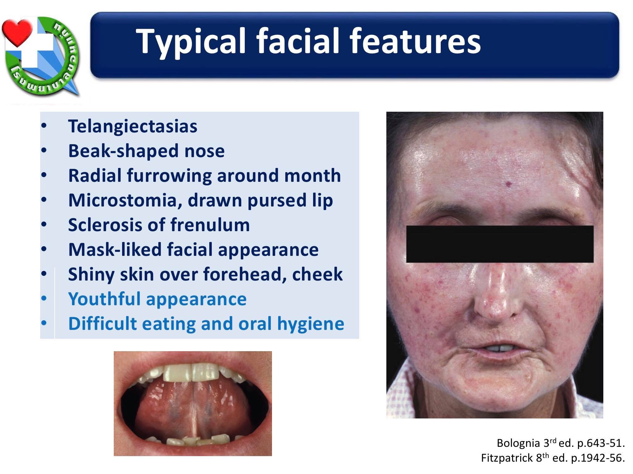 Skin signs in Systemic Sclerosis | HELLO SKIN by หมอผิวหนัง