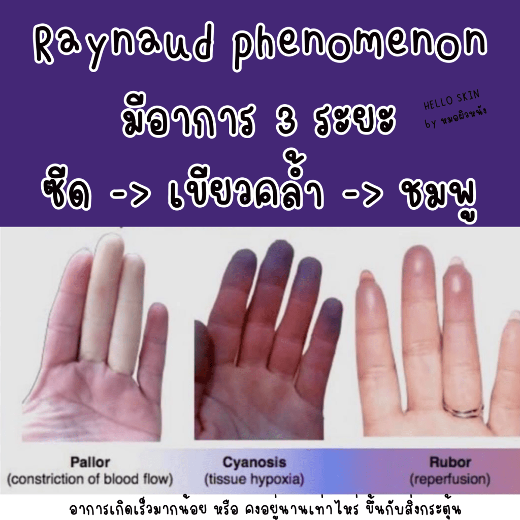Raynaud phenomenon | HELLO SKIN by หมอผิวหนัง