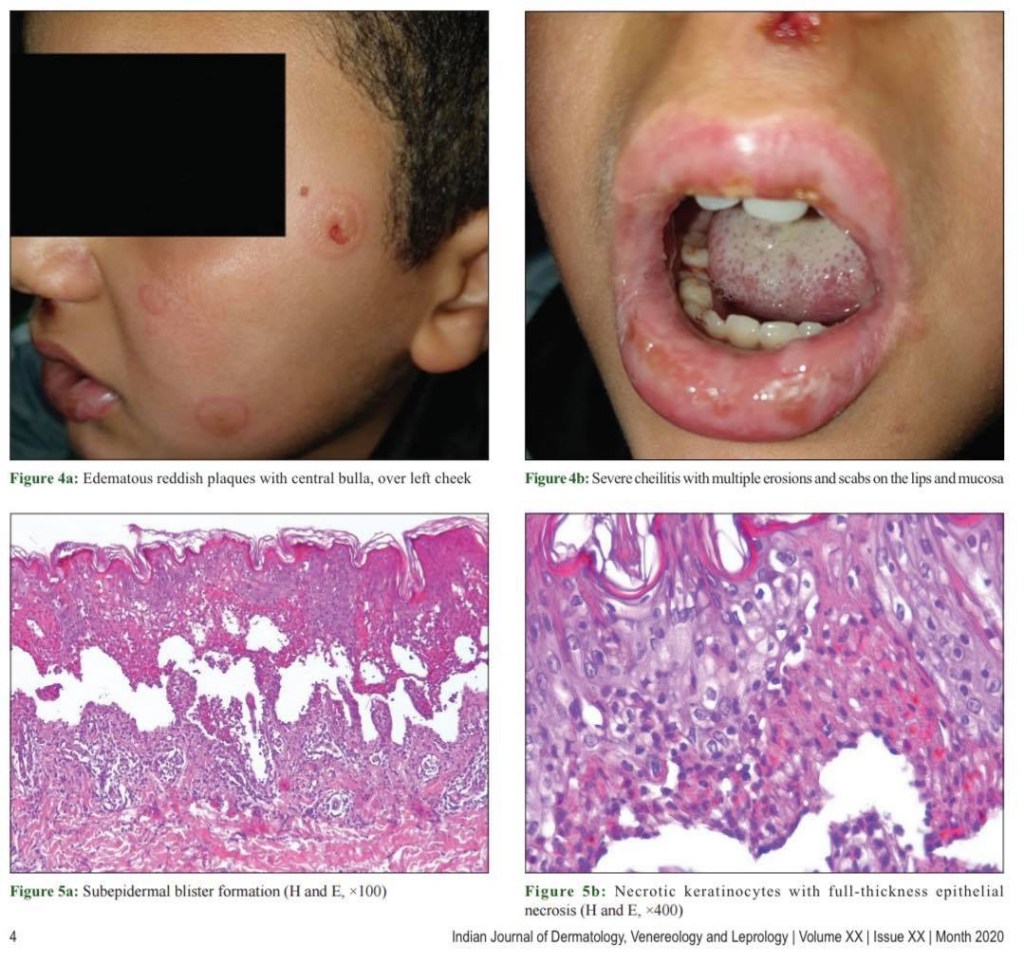 Mycoplasma pneumoniae-induced Rash and Mucositis | HELLO SKIN by หมอผิวหนัง