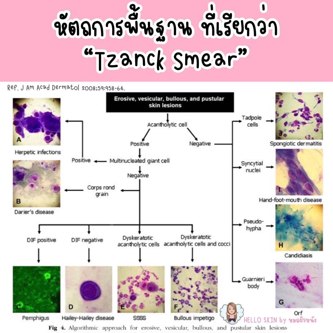 ว่าด้วยเรื่องของ Tzanck smear | HELLO SKIN by หมอผิวหนัง