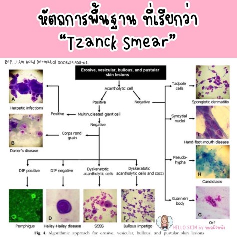 ว่าด้วยเรื่องของ Tzanck smear | HELLO SKIN by หมอผิวหนัง