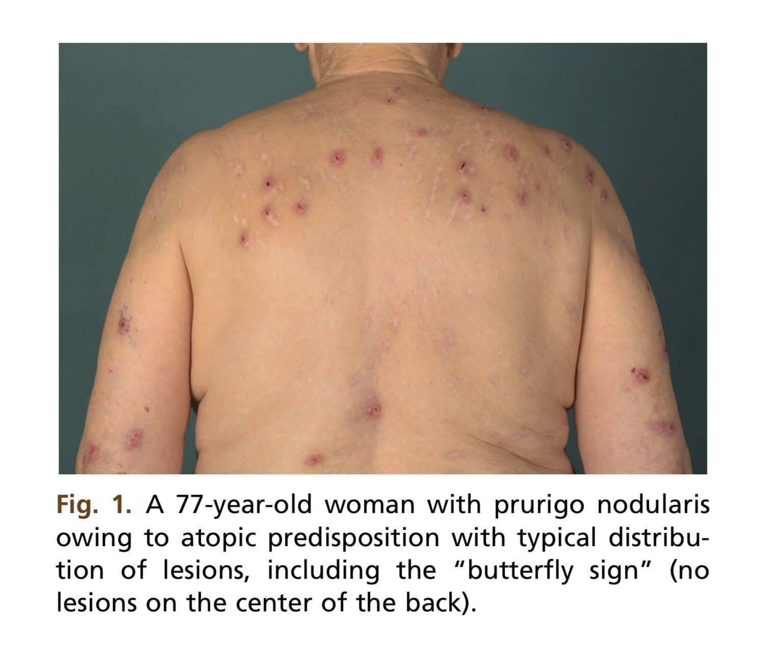 วิธีจัดการตุ่มคันตามตัว (Prurigo nodularis) | HELLO SKIN by หมอผิวหนัง