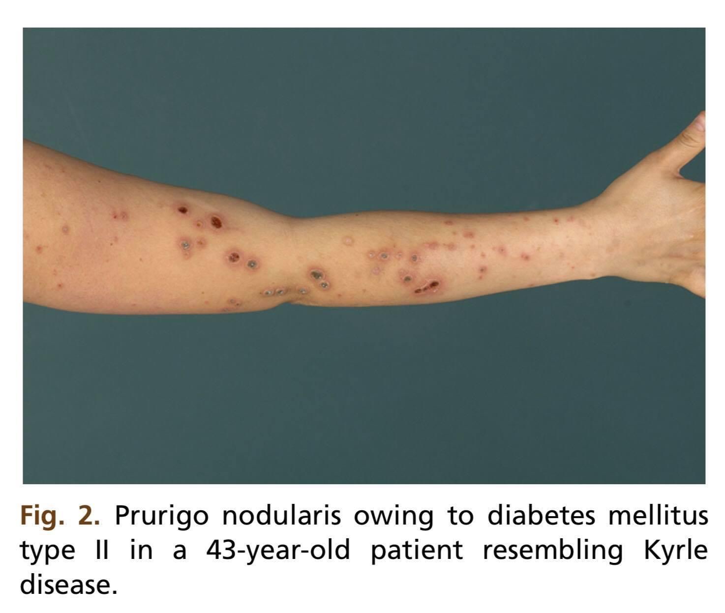 วิธีจัดการตุ่มคันตามตัว (Prurigo nodularis) | HELLO SKIN by หมอผิวหนัง