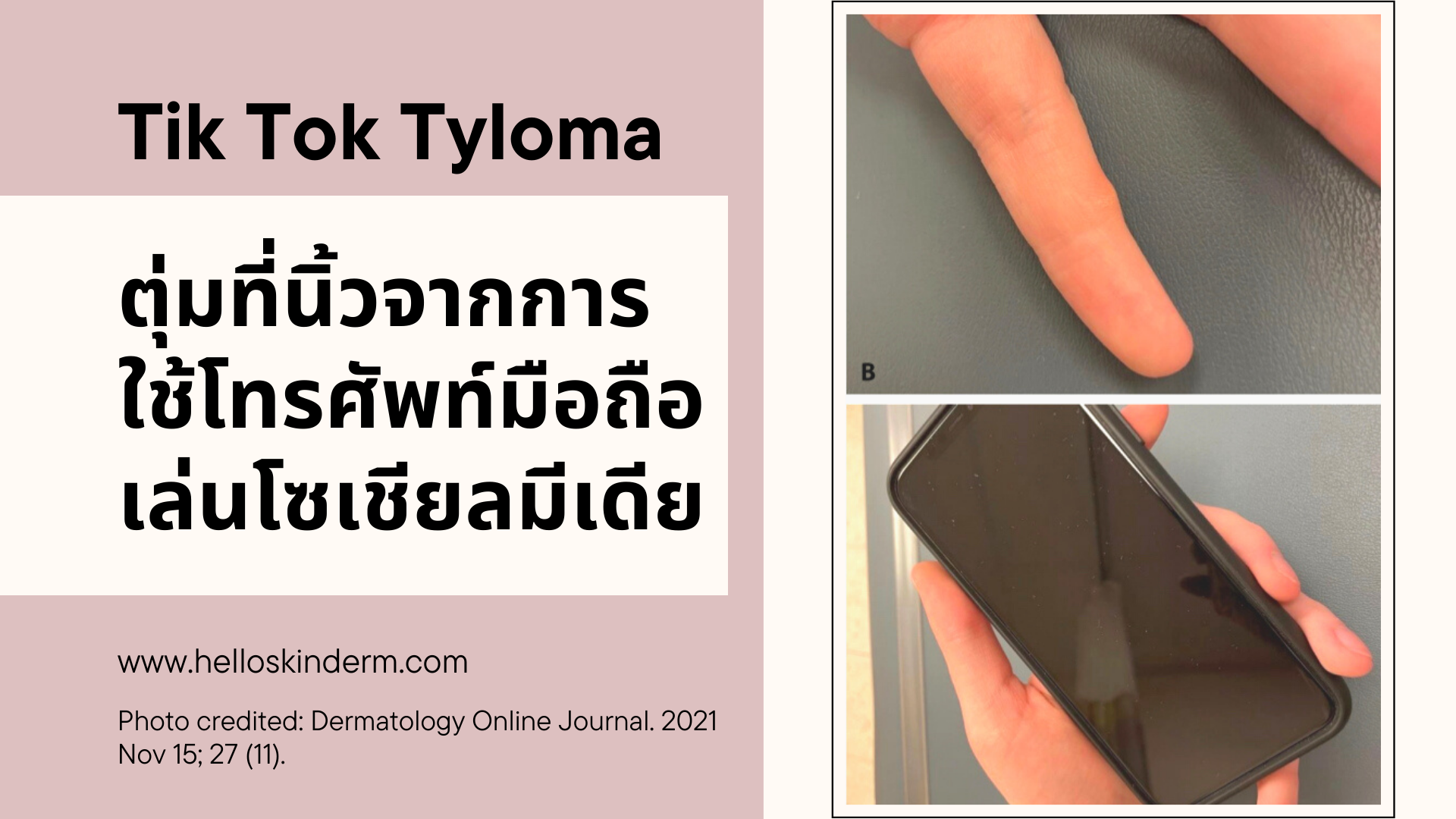 “Tik Tok Tyloma” ตุ่มที่นิ้วจากการเล่นโซเชียลมีเดียประจำ | HELLO SKIN ...