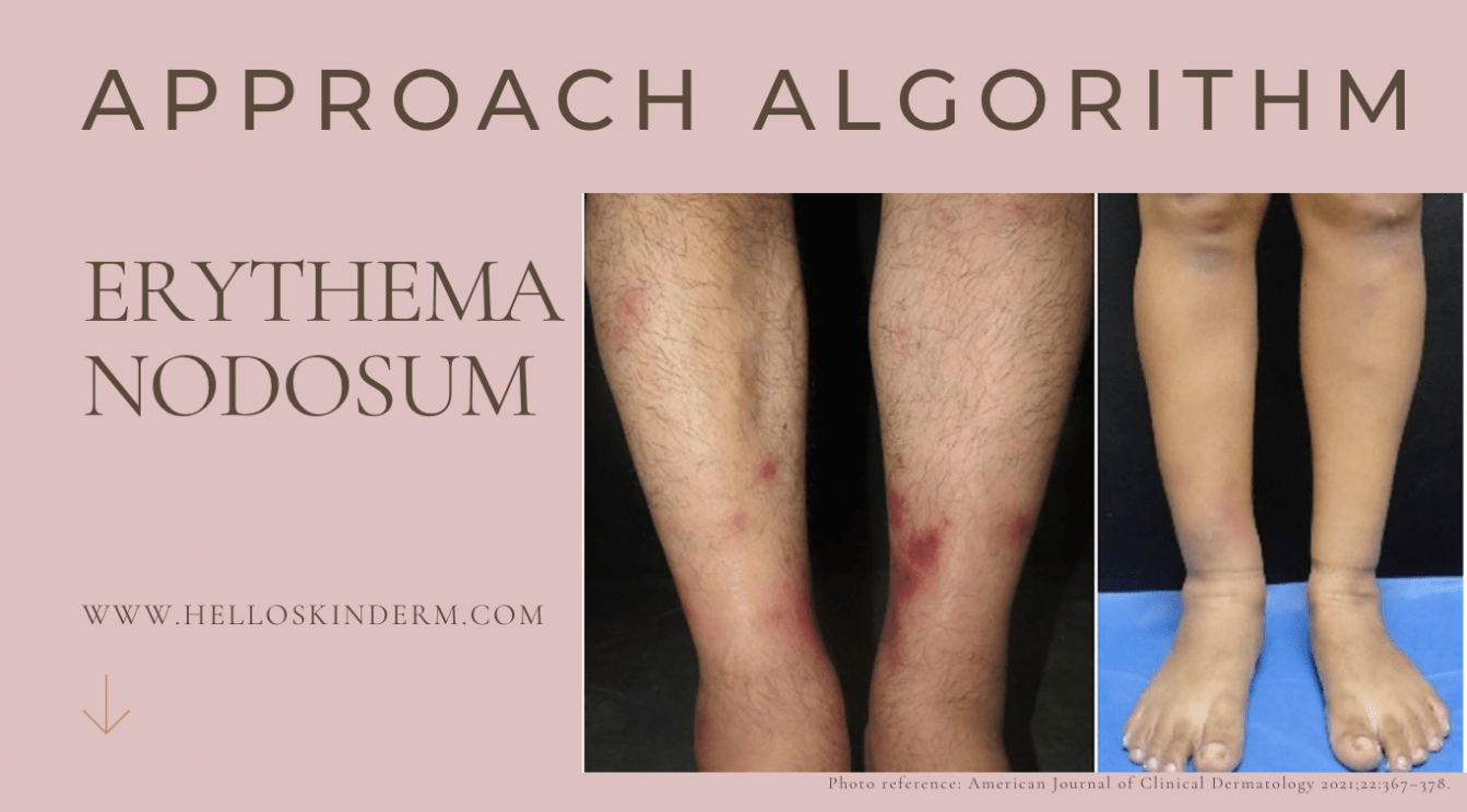 Erythema nodosum (Update 2021) : Approach algorithm | HELLO SKIN by หมอ ...