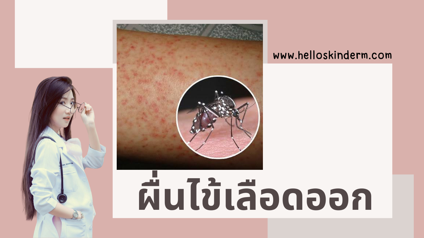 ผื่นไข้เลือดออก (Dengue Skin Rash) | HELLO SKIN by หมอผิวหนัง