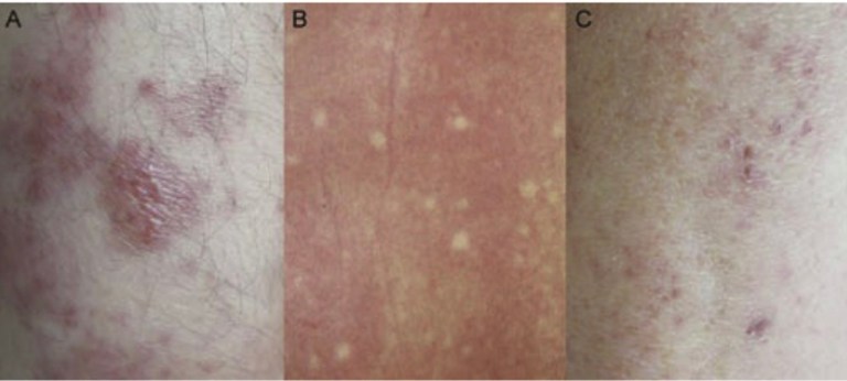 ผื่นไข้เลือดออก (Dengue Skin Rash) | HELLO SKIN by หมอผิวหนัง