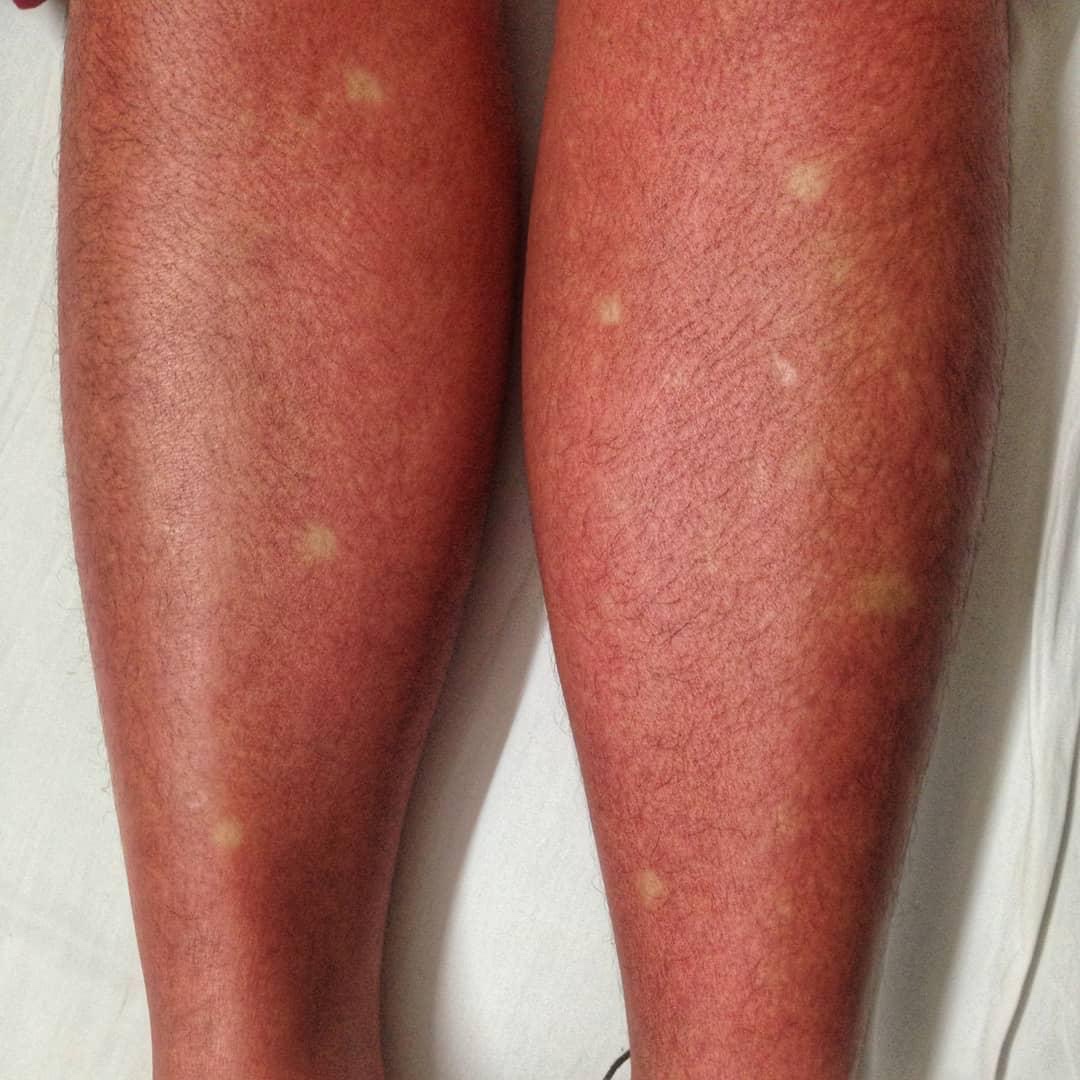 ผื่นไข้เลือดออก (Dengue Skin Rash) | HELLO SKIN by หมอผิวหนัง