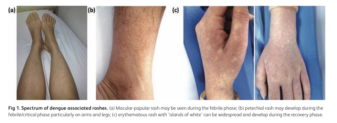 ผื่นไข้เลือดออก (Dengue Skin Rash) | HELLO SKIN by หมอผิวหนัง